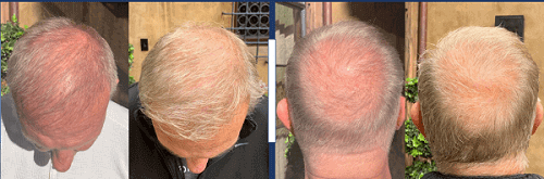 Exosome Hair Therapy - VitalityMD Toronto