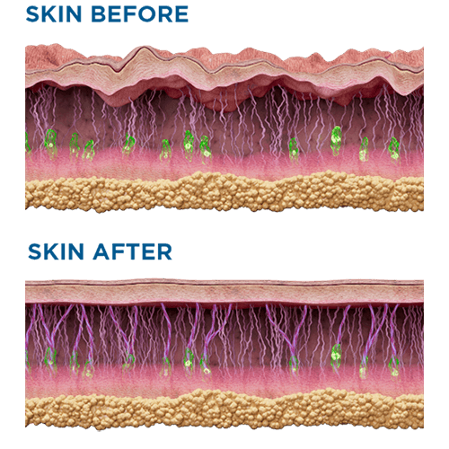 EXION® Fractional RF Skin Treatment Toronto | VitalityMD, Toronto